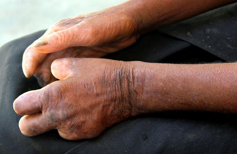 Morogoro yaongoza kwa idadi kubwa ya wagonjwa wa ukoma. | ITV ...